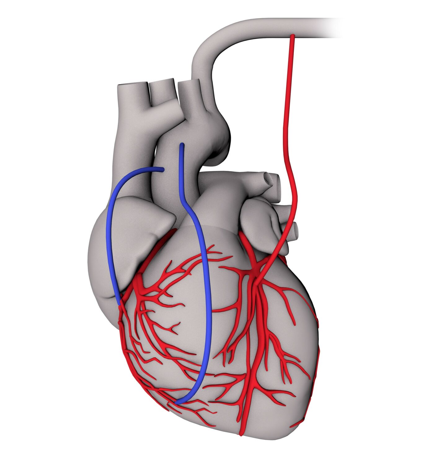 Koronare Bypassoperation - Herzbypassoperation - Klinik für Thorax- und ...